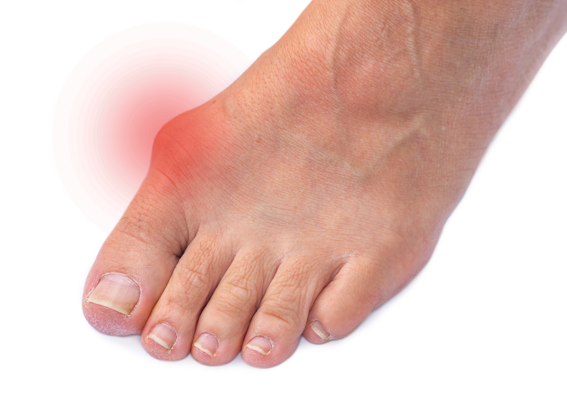 Bunion/Arthritis - Smile & Move Polyclinic