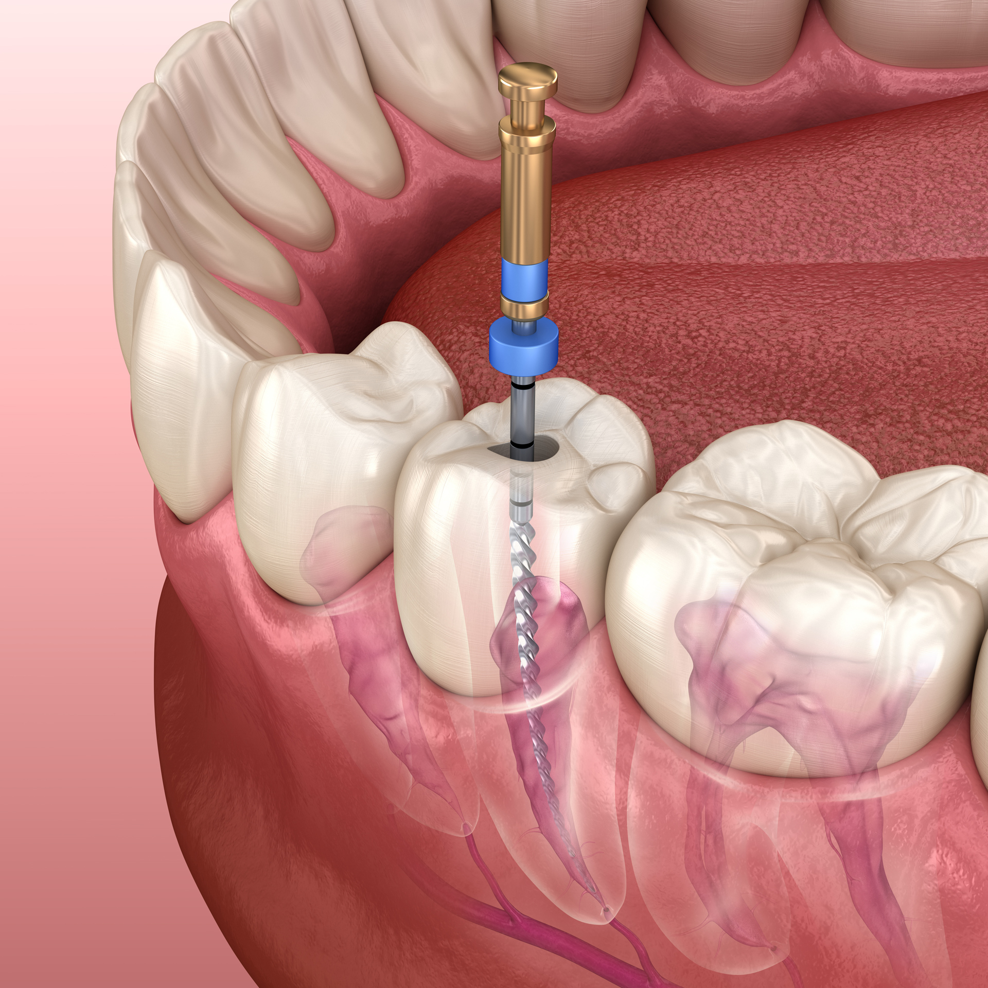 Root Canal Treatment RCT Smile Move Polyclinic